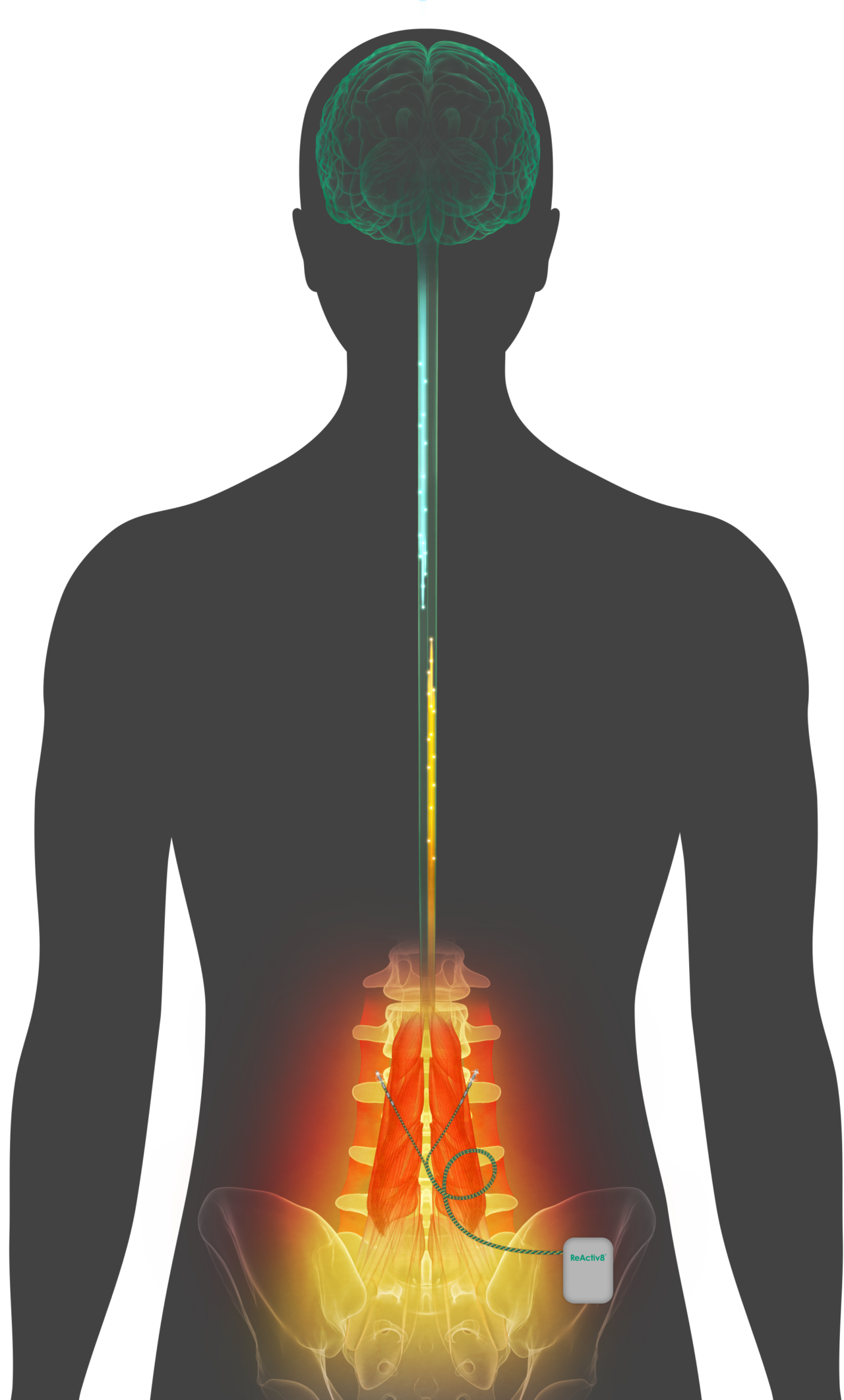 CLBP & Restorative Neurostimulation
